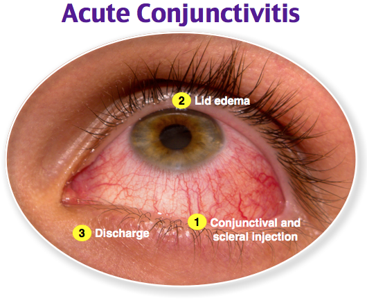 EM@3AM: Traumatic Iritis - emDocs